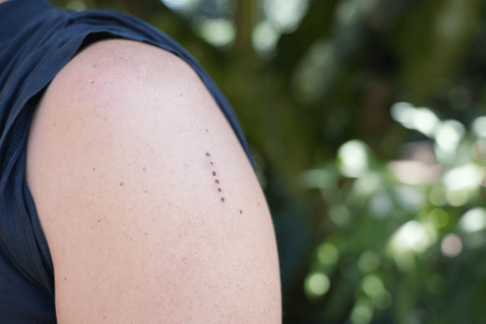 Kambo – Froschgift zur körperlichen und seelischen Heilung